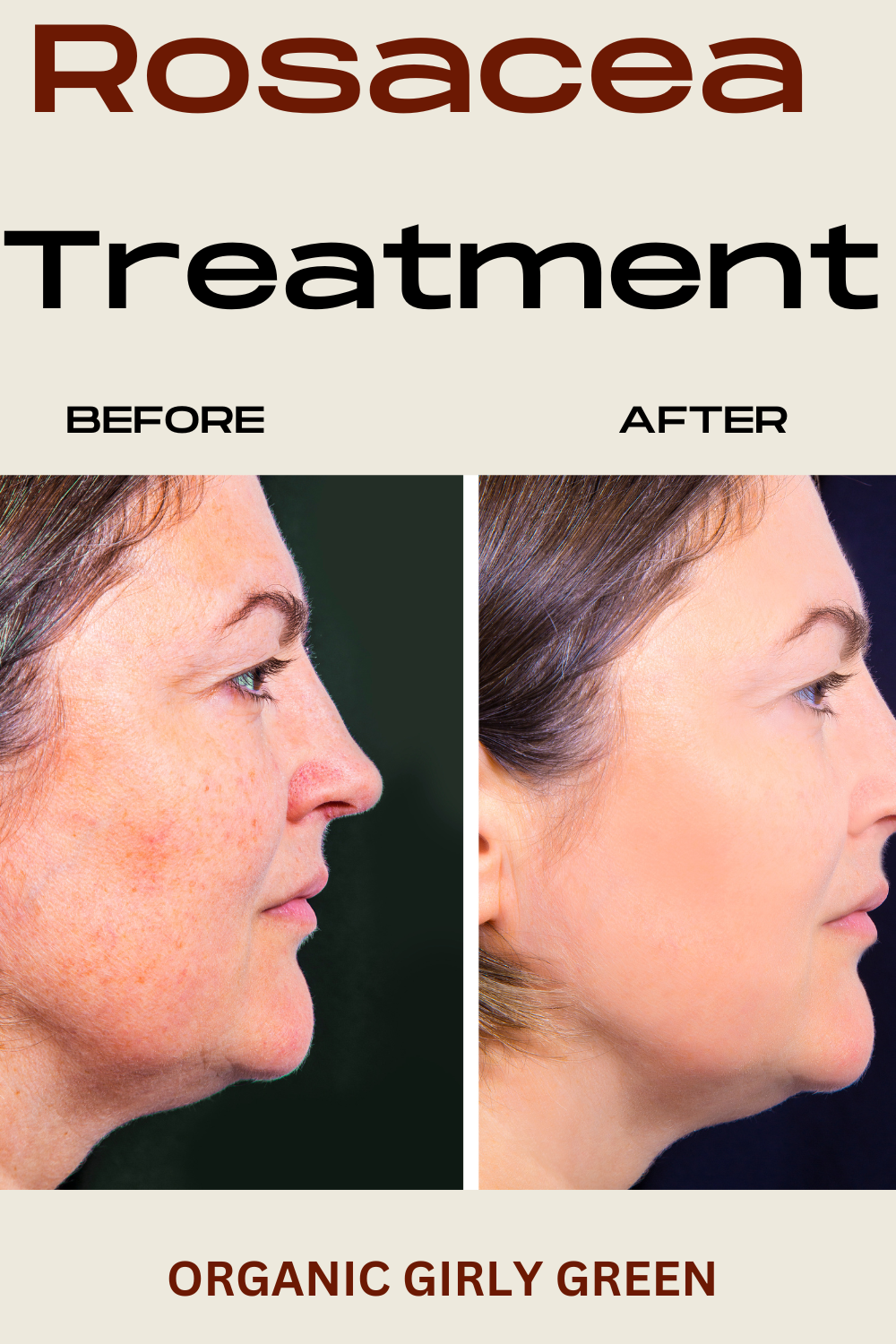 HOW TO PREVENT ROSACEA: THE BEST OILS FOR ROSACEA( CITRON) - ORGANIC ...